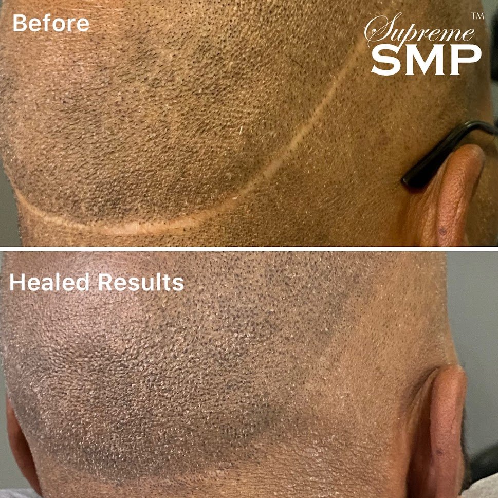Scalp Scar Treatment | Massachusetts, USA | Supreme SMP