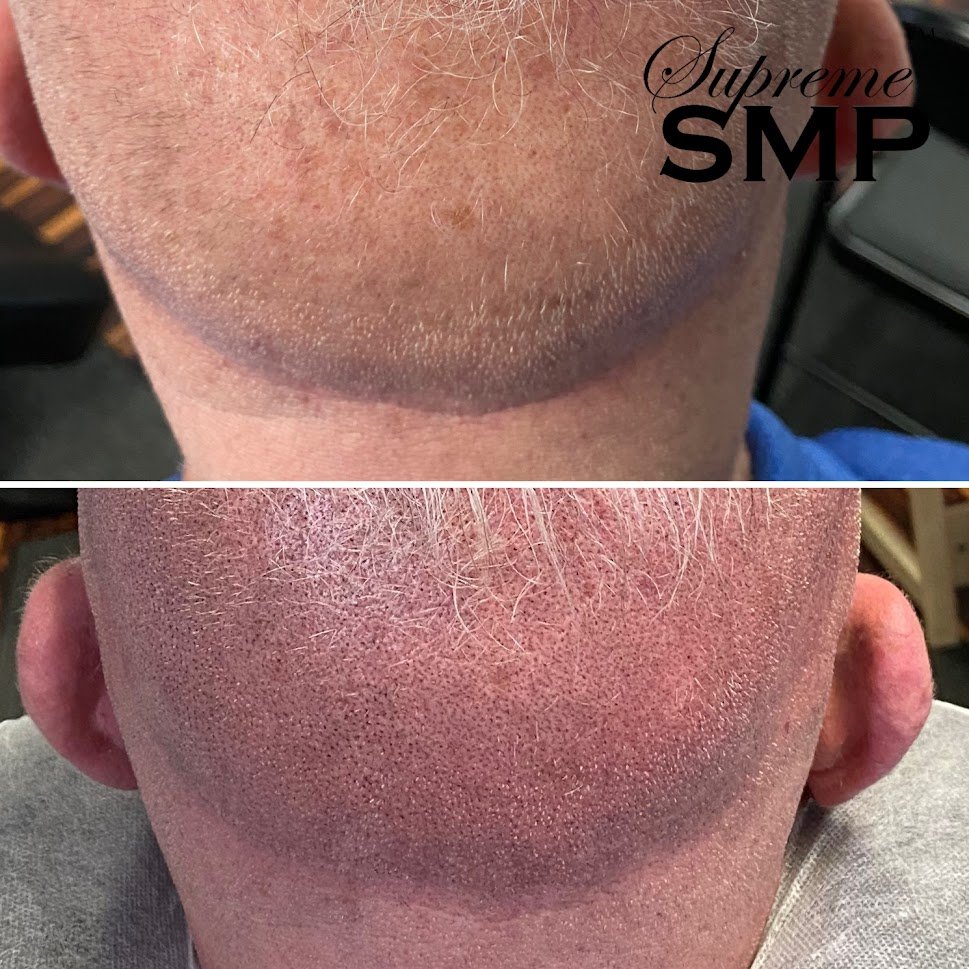 Scalp Scar Treatment | Massachusetts, USA | Supreme SMP