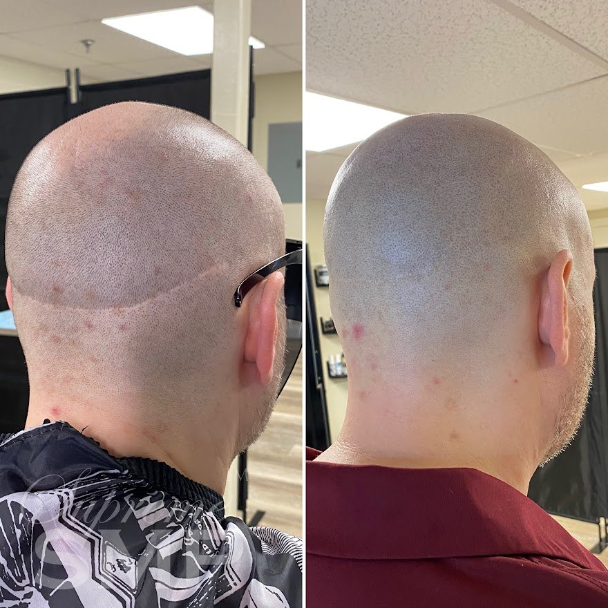 Scalp Scar Treatment | Massachusetts, USA | Supreme SMP