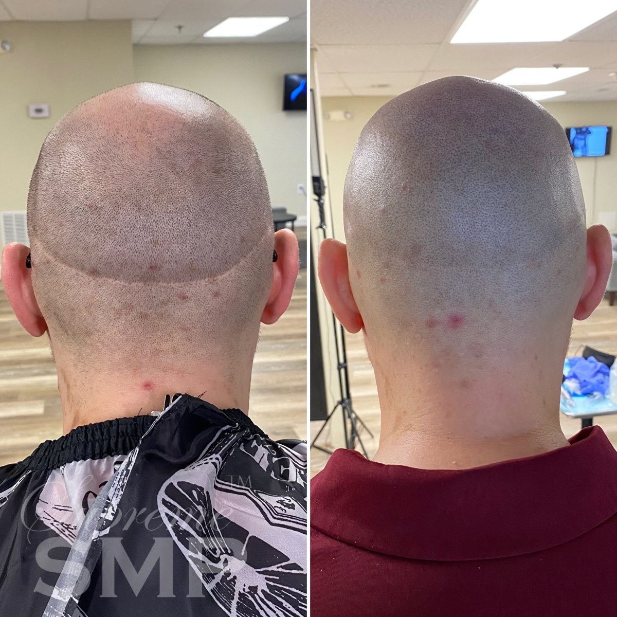 Scalp Scar Treatment | Massachusetts, USA | Supreme SMP