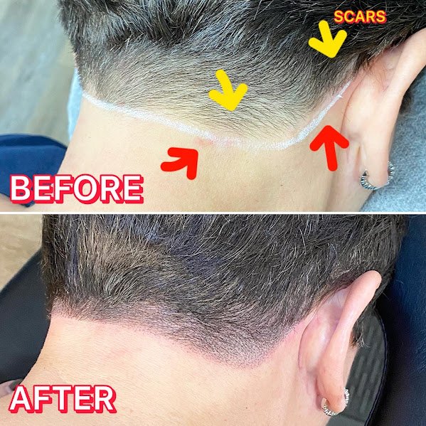 Scalp Scar Treatment | Massachusetts, USA | Supreme SMP